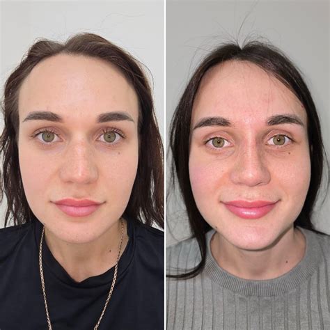 Пластический хирург Днепр Ділюся результатом До Після 10 днів після риносептопластики 👃🏻 ⠀ ☝🏻