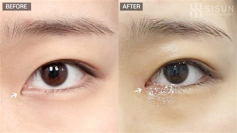 [무보정전후영상] 갈고리눈 몽고주름제거 갈고리트임 1주 Youtube