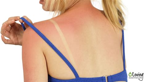 Lavender Oil For Sunburn With Cooling Compress And Diy Recipes Loving