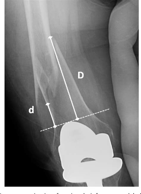 Figure 1 From Is The Fracture Pattern In Periprosthetic Fractures