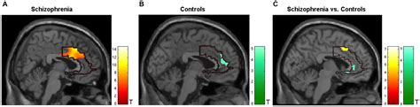Group Differences In Anterior Cingulate Cortex Activation