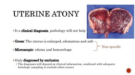 Uterine Atony Ppt Postpartum Hemorrhage Powerpoint Presentation Id