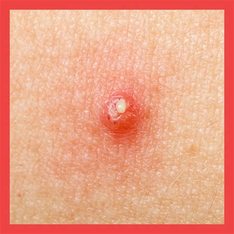 Heres The Right Way To Deal With Every Type Of Bump On Your Skin