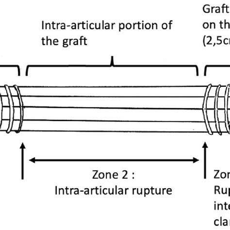 Four Strand Hamstring Tendon Graft Download Scientific Diagram