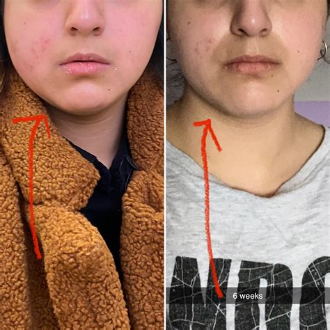 Before And Six Weeks After Right Masseter Muscle Botox R