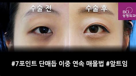 20대 중반 여성 7포인트 단매듭 이중매몰과 앞트임 수술 20대 쌍꺼풀매몰 앞트임 비씨아이 수술노트 Youtube