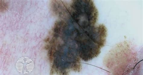 Melanoma In Situ 9 Dermoscopy Image