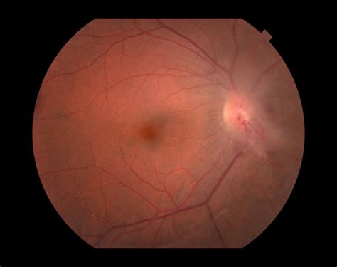 Htlv 1 Associated Intermediate Uveitis Associated With Older Age Good