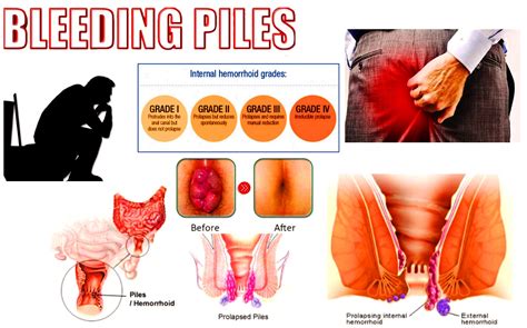 External Hemorrhoids Before And After