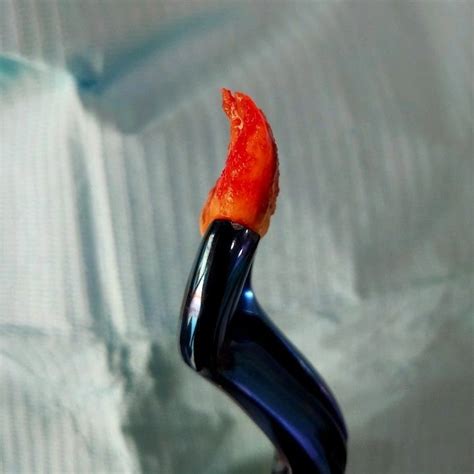 Syed Ahsan Ahmad On Linkedin Extraction Of Maxillary 3rd Molar With