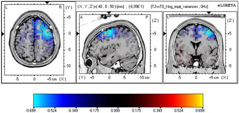 Sloreta Slice Viewer T2 Vs T0 Loreta Statistical Maps Of The