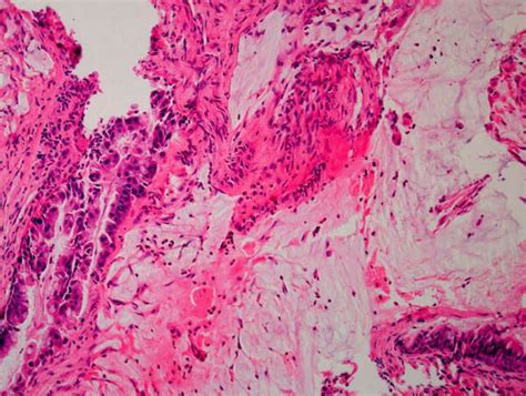 Histopathology Slide Showing Pools Of Mucin Within The Extracellular