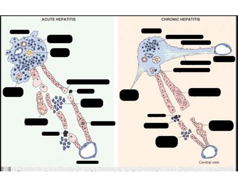 Acute Vs Chronic Hepatitis Quiz