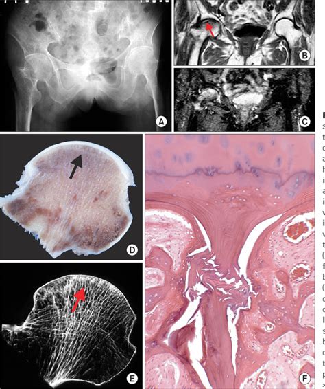 Figure 2 From Subchondral Insufficiency Fractures Of The Femoral Head