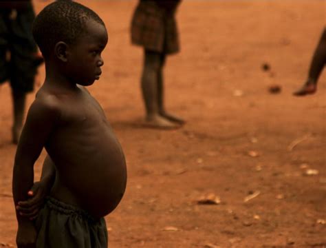 Odrimedia News On Linkedin Kwashiorkor Vs Marasmus Key Differences