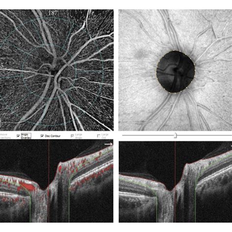 Octa Images With Angio Retina And Angio Disc Mode A Superficial Download Scientific Diagram