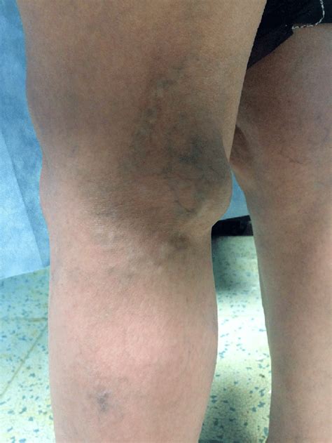 Popliteal Cyst Acl Ganglion Cyst Meniscal Cyst Baker Cyst