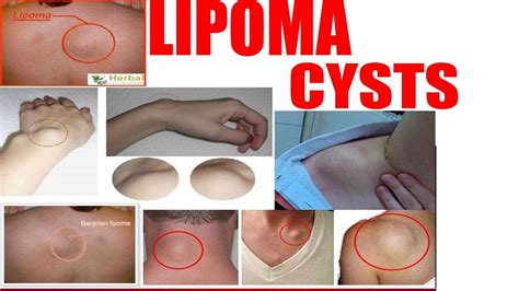 Lipoma And Cyst Difference