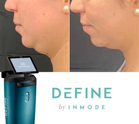 Define Tightening Rejuvenation Skin Wellness And Aesthetics