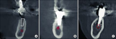 Distance D Between The Implant Fixture And The Inferior Alveolar
