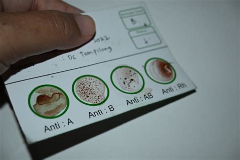 Experts Call To Update Testing Strategies For Hdfn