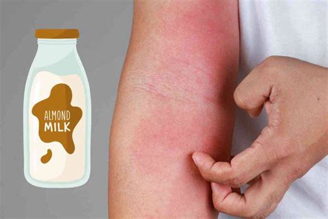Can You Be Allergic To Almond Milk Thirstythrive