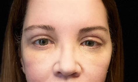 Before And 13 Days Post Op Upper Bleph And Endo Brow Lift 2nd Try