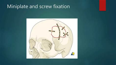 Operative Instruments In Craniotomy Pptx