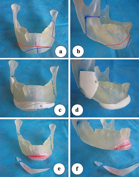 3 3d Printed Model For Surgical Planning A Landmark And Osteotomy