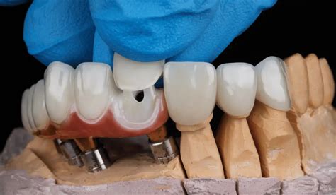 Cosmetic Dentistry What It Is Procedures And Types