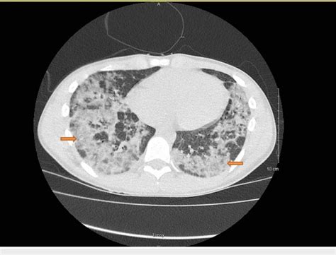 Chest X Ray Showing Left Basilar Airspace Disease Dow