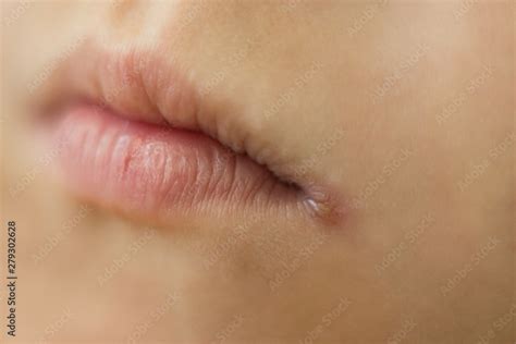 Zdjęcie Stock Skin Problems Angulitis Angular Stomatitis Angular