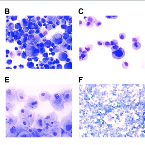 Primary Bone Sarcoma And Sts Cell Cultures Primary Tumor Cell Cultures