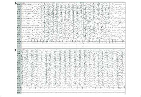 Eeg Demonstrated Generalized Slow Spike And Wave Complexes 16 2 Hz