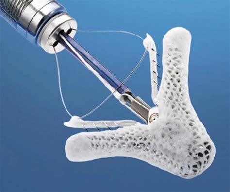 Mitraclip Tratamento Percutâneo Da Insuficiência Mitral Médico