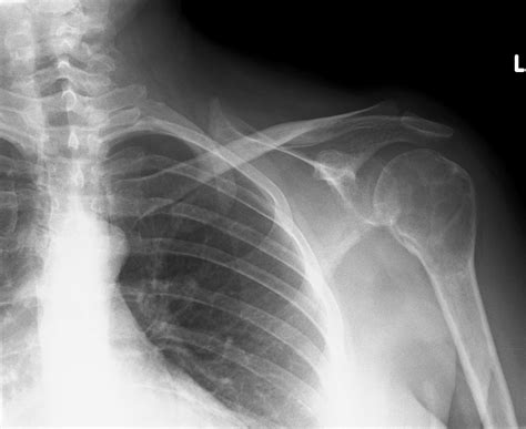 Clear Cell Chondrosarcoma Humerus Image