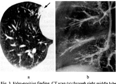 Figure 1 From High Resolution Ct And Bronchography In The Assessment Of Bronchiectasis
