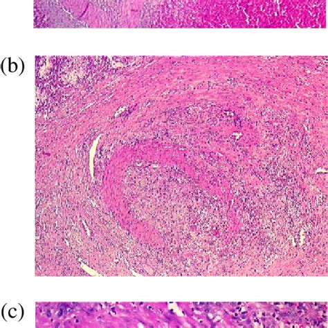 Giant Cellulitis Like Sweet Syndrome Initial Presentation With