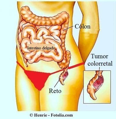 Sintomas da obstrução intestinal causas e tratamento