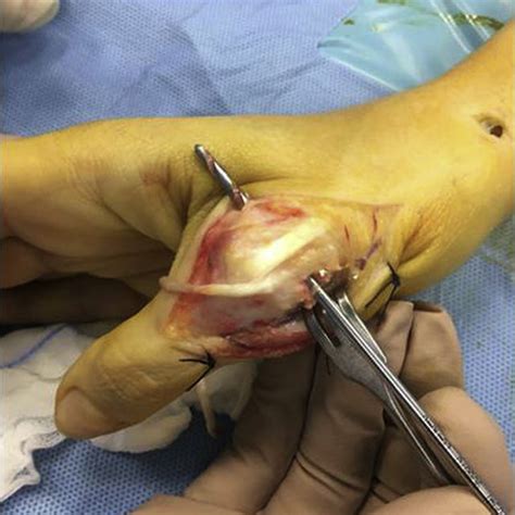 Radiological Signs Of Subluxation Of First Mcp Joint After Chronic Ucl Download Scientific