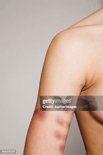 Bruise On Upper Arm