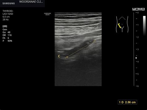 우하복부 압통 맹장이하 충수염 게실염 소견은 없고 확장된 충수만 수술 의뢰하였으나 외과병원에서 초음파 후 게실염 치료