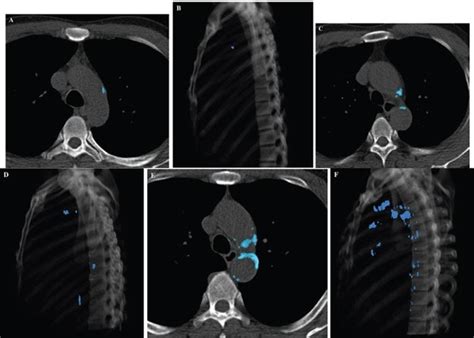 Thoracic Aortic Calcification Data Could Help Predict Cac Risk Auntminnie