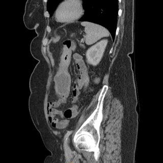 CT Abdomen Pelvis Coronal And Sagittal View Respectivelylong Segment