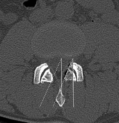 Comparison Between Contralateral Right Dotted Line And Ipsilateral