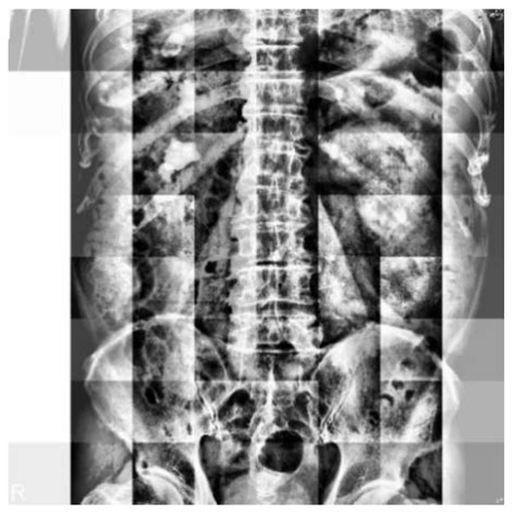 Design And Validation Of A Deep Learning Model For Renal Stone Detection And Segmentation On
