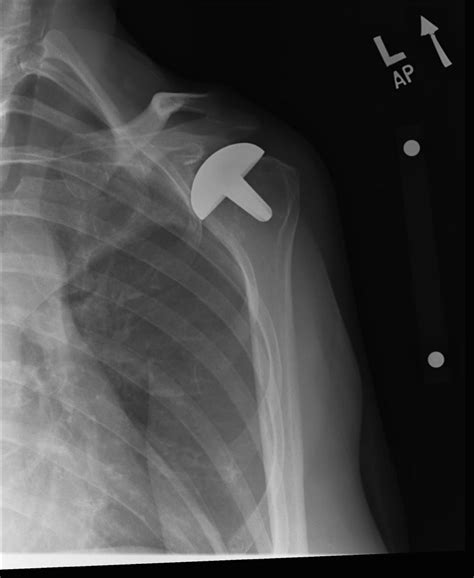 Dr Bailie To Publish His Long Term Data On Resurfacing Arthroplasty Of