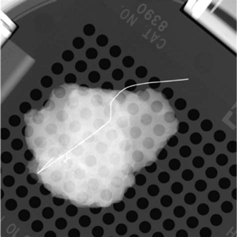 Needle Localization Biopsy Of Nonpalpable Breast Lesions Plastic Surgery Key