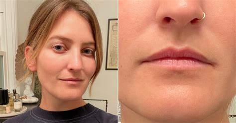 I Tried Cheek Filler See Before And After Photos Popsugar Beauty Uk