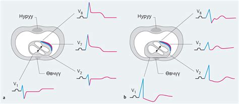 Зүрхний цахилгаан бичлэг ЭКГ Electrocardiography Ecg Erdemed